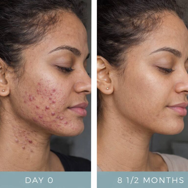 Hormonal Acne Explained: How To Identify It And Treat It Safely